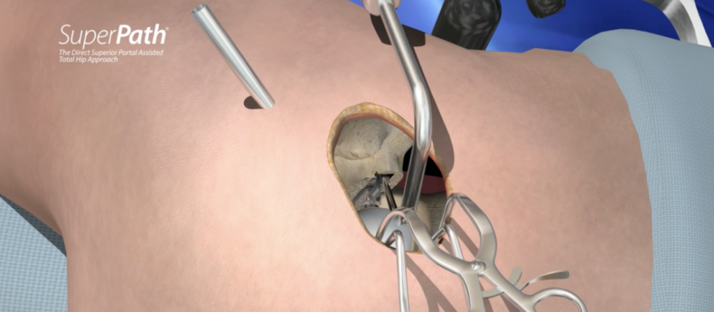 Advantages of SuperPath - Capstone Orthopedics