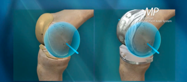 Medial-Pivot Knee System Animation - Video - Capstone Orthopedics